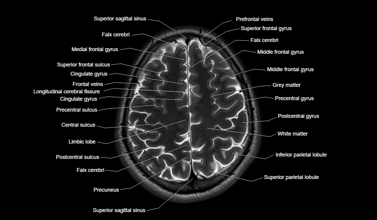 Brain Axial Anatomy