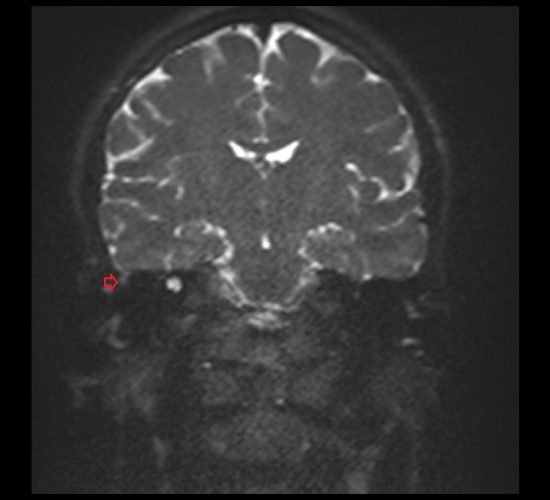 cholesteatoma MRI | Radiology article on cholesteatoma