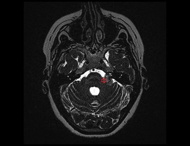 Internal Acoustic Meatus Mri