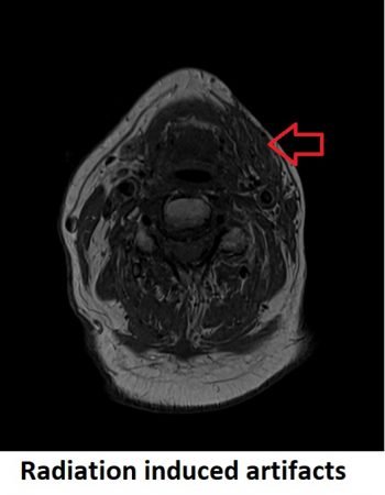 Radiation induced artifact MRI | Radiotherapy mri artifact